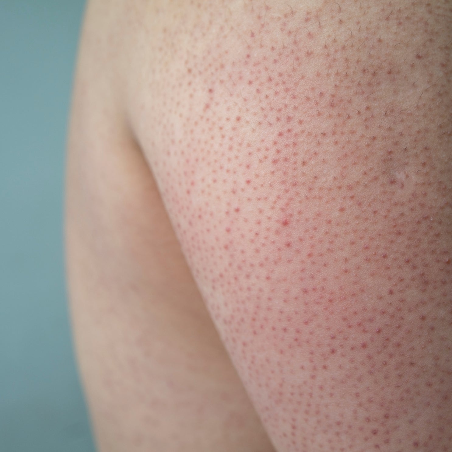 Keratosis pilaris causes and treatment cream